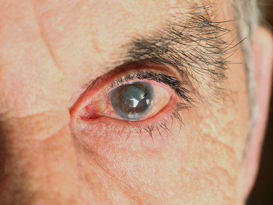 Eye Diseases A to Z-all for your vision - HealthPulls