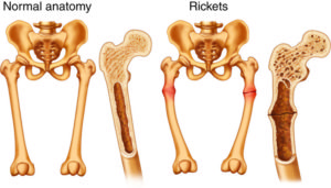 Rickets in Children, Symptoms, Pathogens and Best Treatment