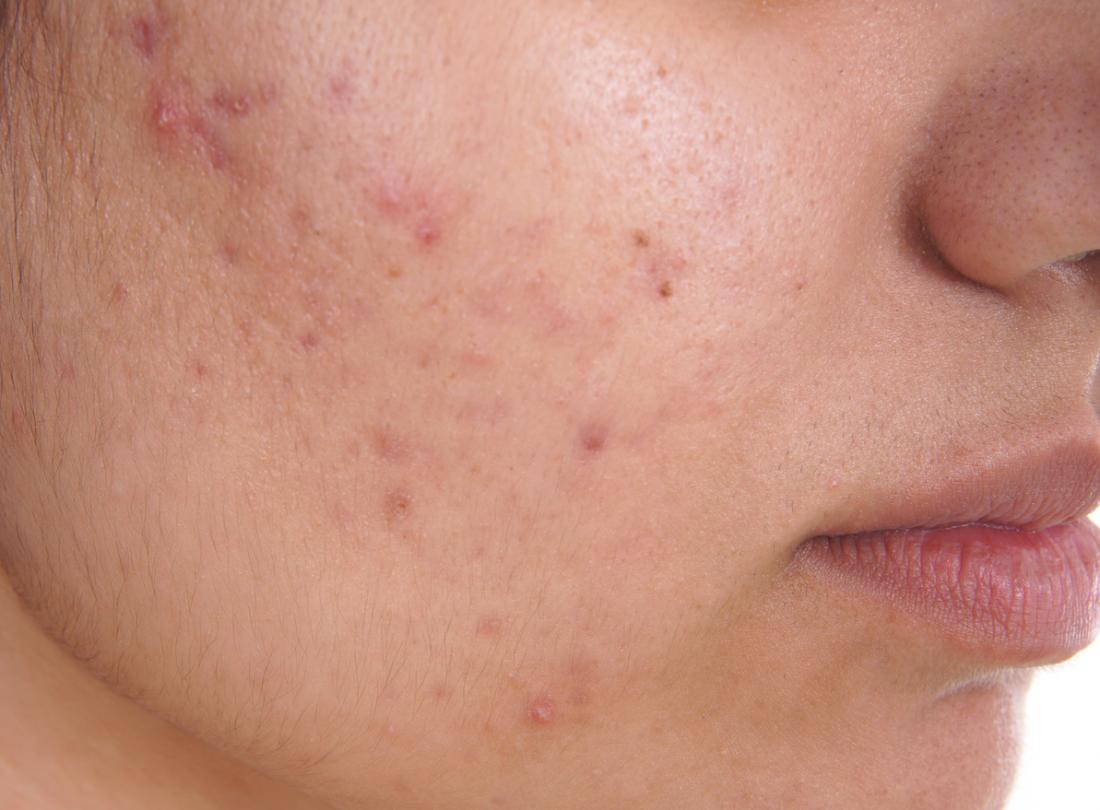 How to Rid of Acne During Pregnancy Best tips in 2020 - HealthPulls
