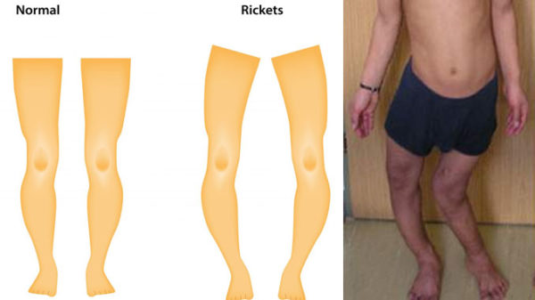 Ragitis in Kinders, simptome, Patogene en beste behandeling