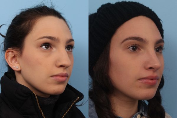 How Rhinoplasty Surgery is done? Whole Procedure - HealthPulls