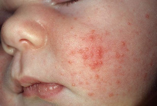 Baby Acne Causes, Symptoms & Home Treatment - HealthPulls