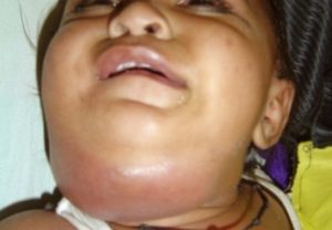 Ludwig's angina causes, symptoms, management - HealthPulls