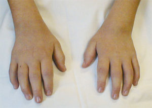 Juvenile Rheumatoid Arthritis: Causes, Classifications & Complications