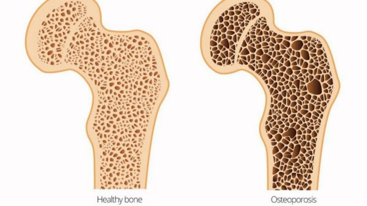 Osteomalacia: Overview, Causes, Treatment and Conclusion - HealthPulls