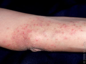 Celiac Disease Rash: Overview, Symptoms and Treatment - HealthPulls