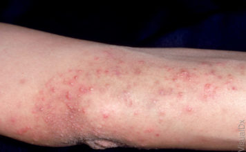 Celiac Disease Rash: Overview, Symptoms and Treatment - Healthpulls