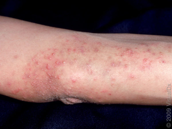 Celiac Disease Rash: Overview, Symptoms and Treatment - HealthPulls