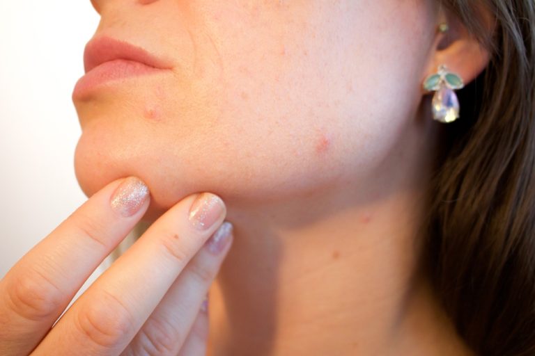 Dark Complexion: 4 Major Causes & Rid Of Dark Complexion - HealthPulls