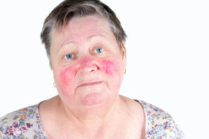 Ruddy Complexion and Redness Causes, how to get rid of it? - HealthPulls