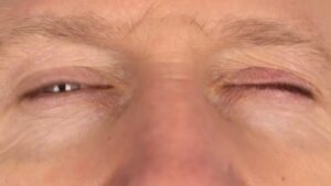 Excessive Eye Blinking: Causes, Signs & treatment - HealthPulls