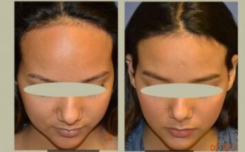 Forehead Reduction Surgery: How To Reduce Forehead?