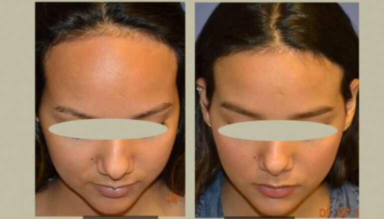 Forehead Reduction Surgery: How To Reduce Forehead?