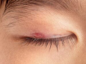 How To Treat Ingrown Eyelash (Trichiasis)? 4 Treatments