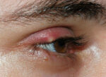 How To Treat Ingrown Eyelash (Trichiasis)? 4 Treatments