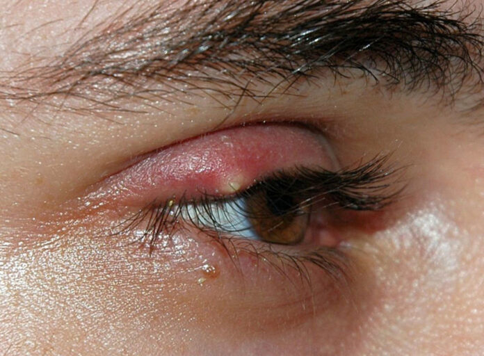 How To Treat Ingrown Eyelash (Trichiasis)? 4 Treatments