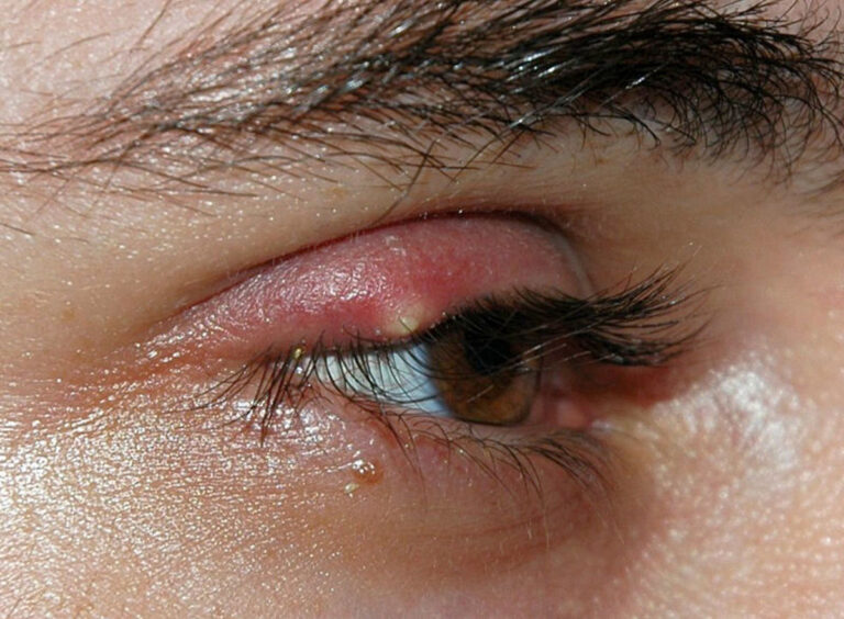 How To Treat Ingrown Eyelash (Trichiasis)? 4 Treatments