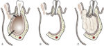What Is Marsupialization? - Healthpulls